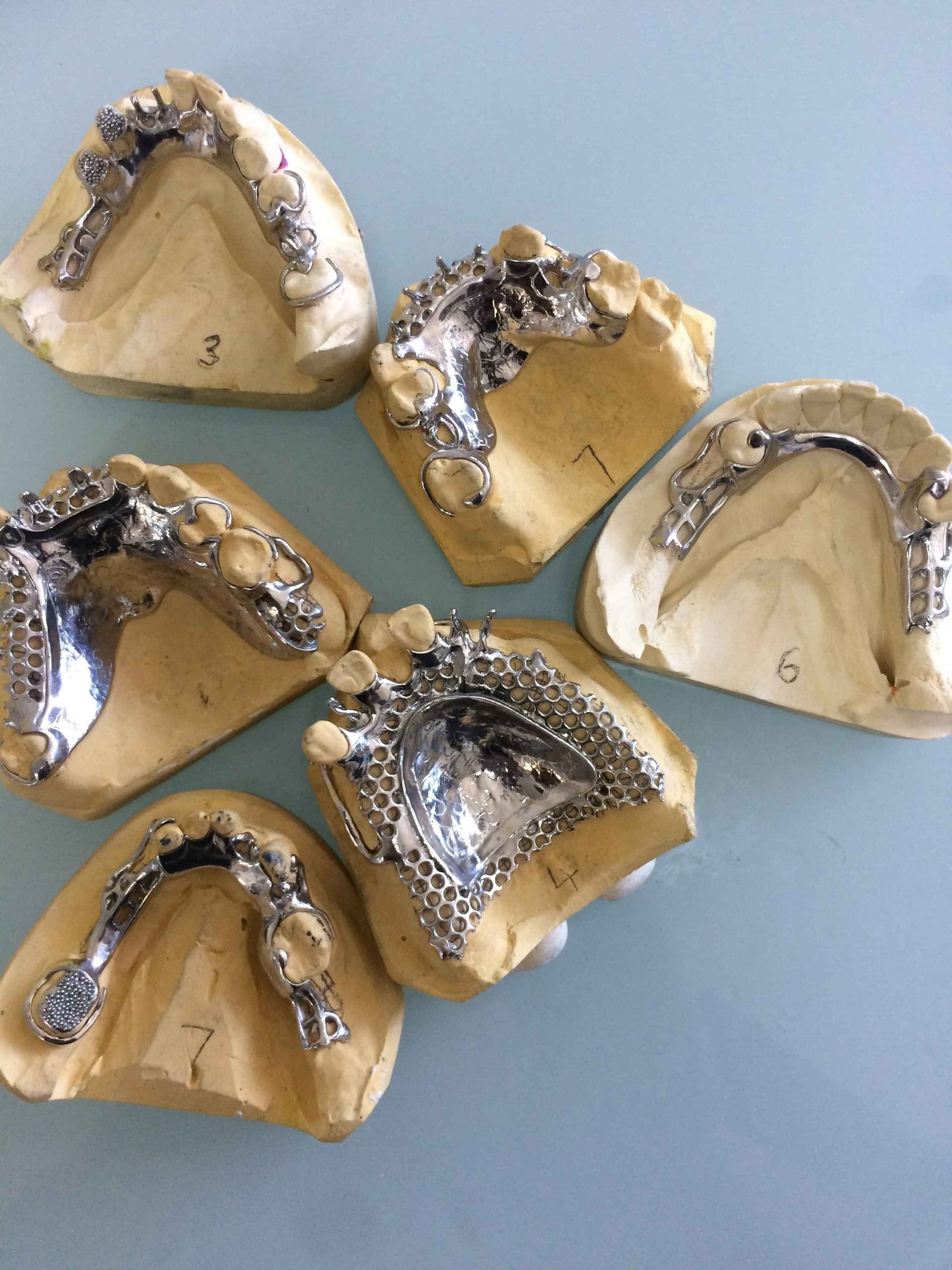 Dentures Cobalt Chrome Dental Laboratory Blackburn | Dazzling Dentures